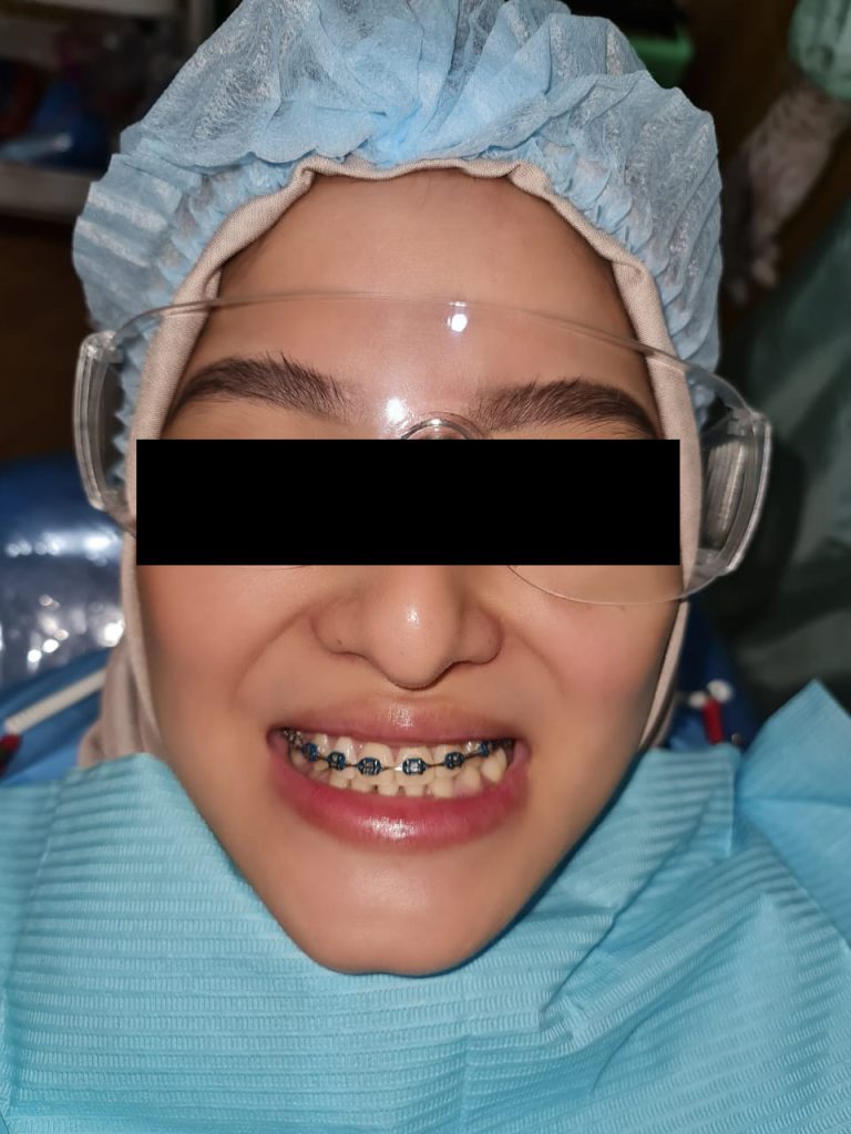 Behel Gigi – Kyoreen Dental Aesthetic