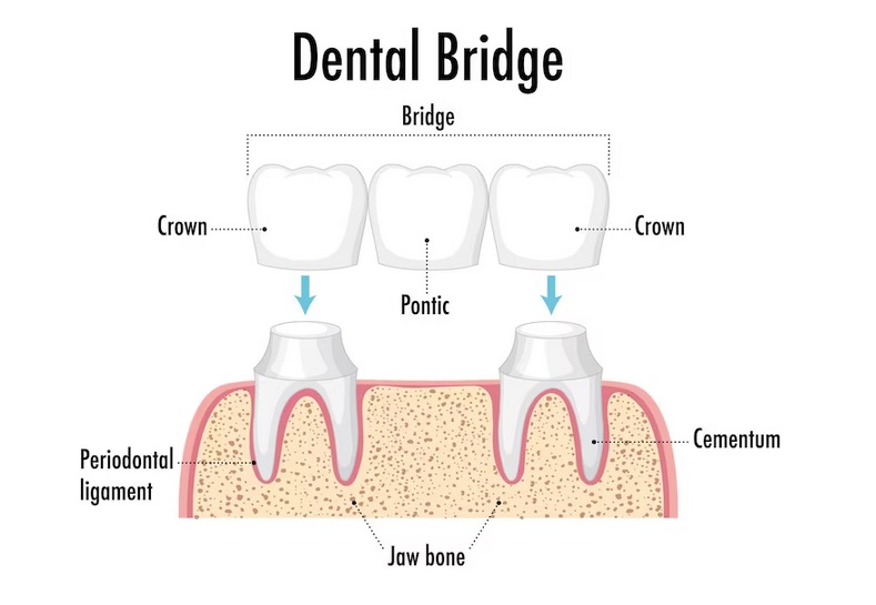 Jenis Gigi Palsu Lepasan dan Permanen – Kyoreen Dental Aesthetic