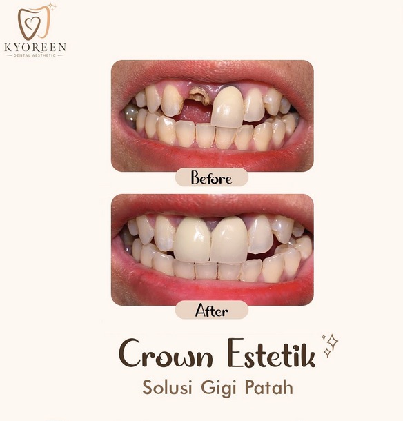 Perawatan Gigi Estetik di Kyoreen Dental Aesthetic – Kyoreen Dental ...